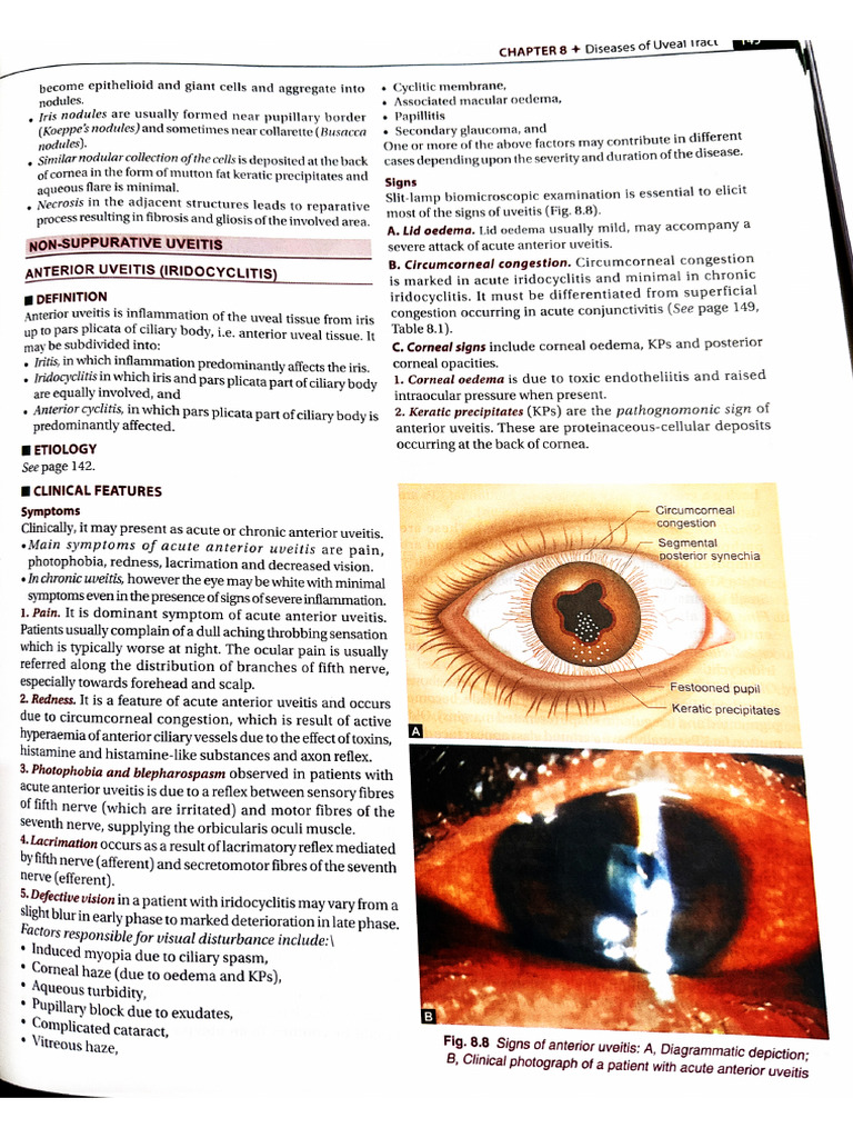Anterior Uveitis | PDF