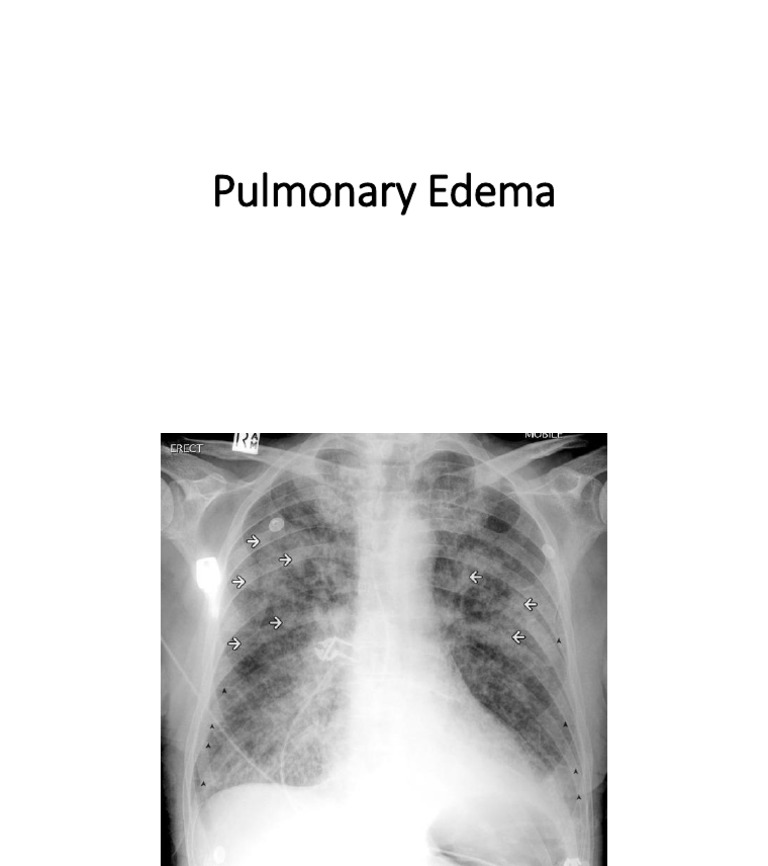 Pulmonary Edema Pdf