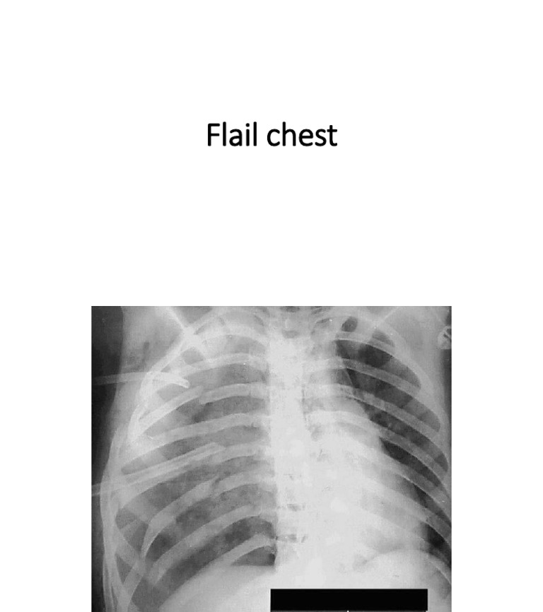 Flail Chest | PDF