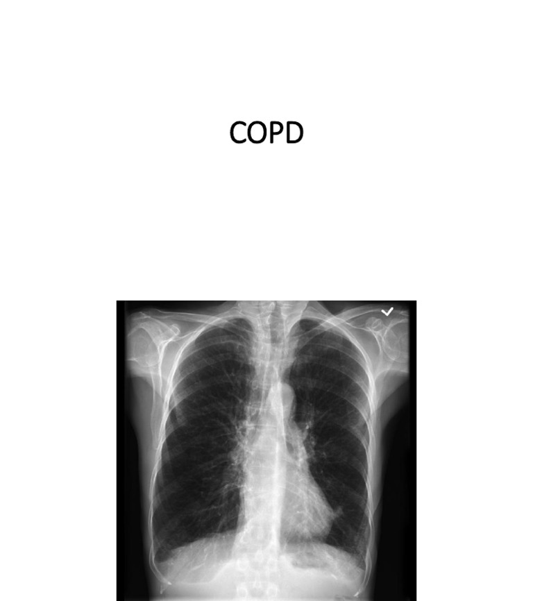 Copd | PDF