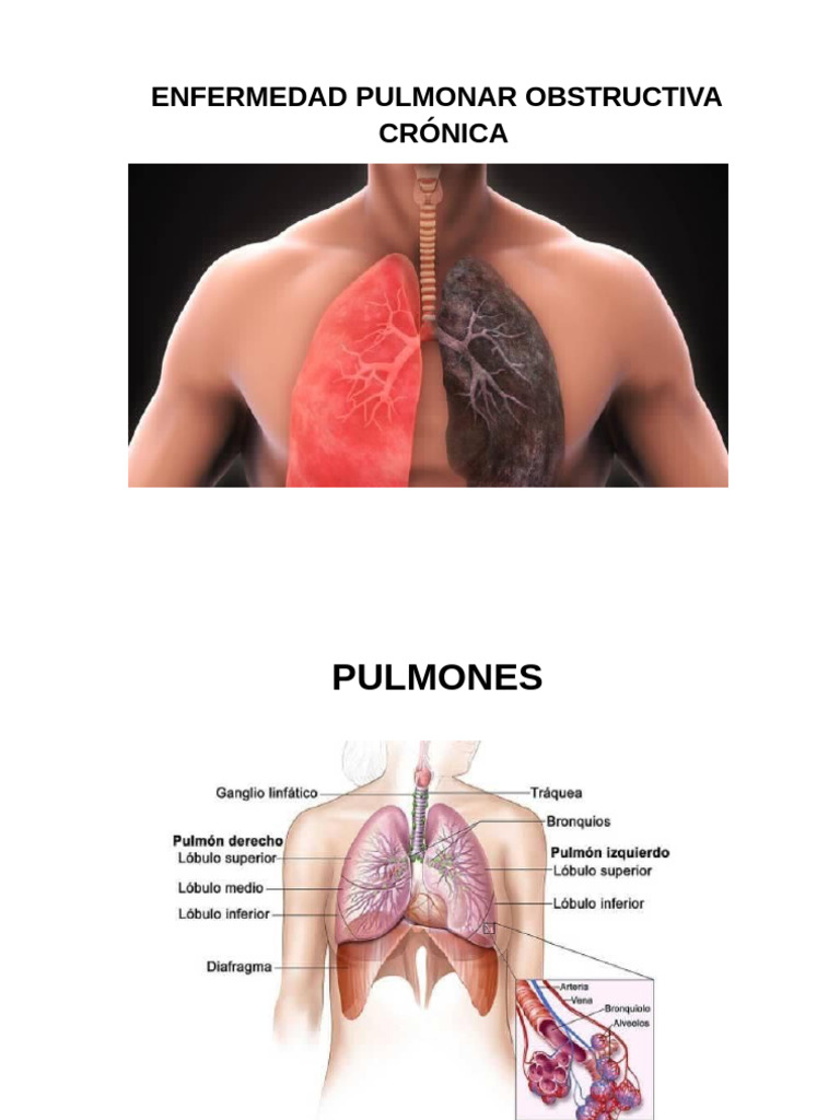 Tema Epoc Enfermedad Obsturtiva Cronica Pulmonar | PDF | Tos | Enfermedad pulmonar obstructiva ...