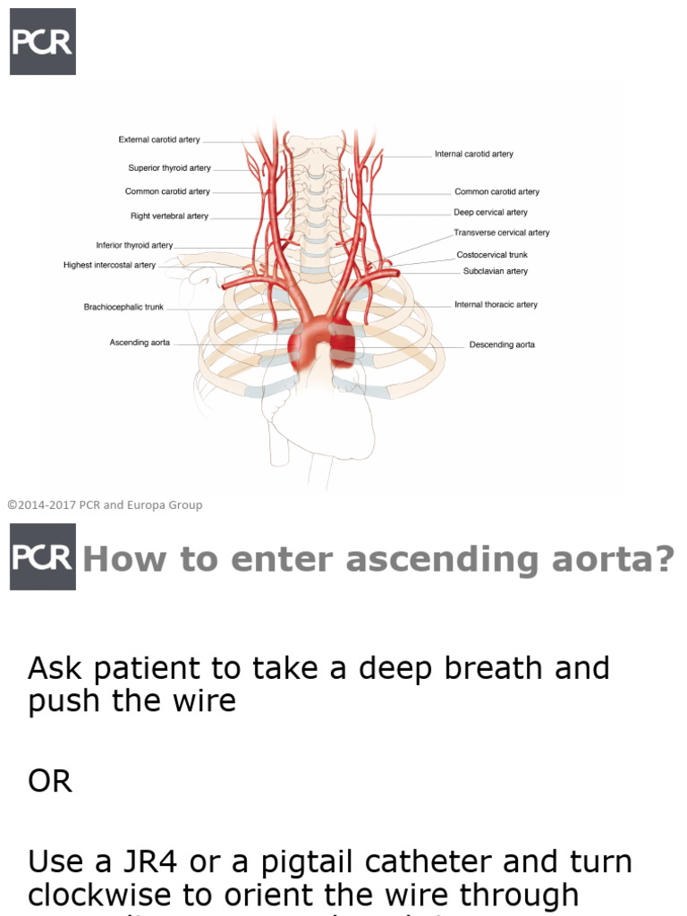 Radial Sub Clavian Navigation 8 | PDF