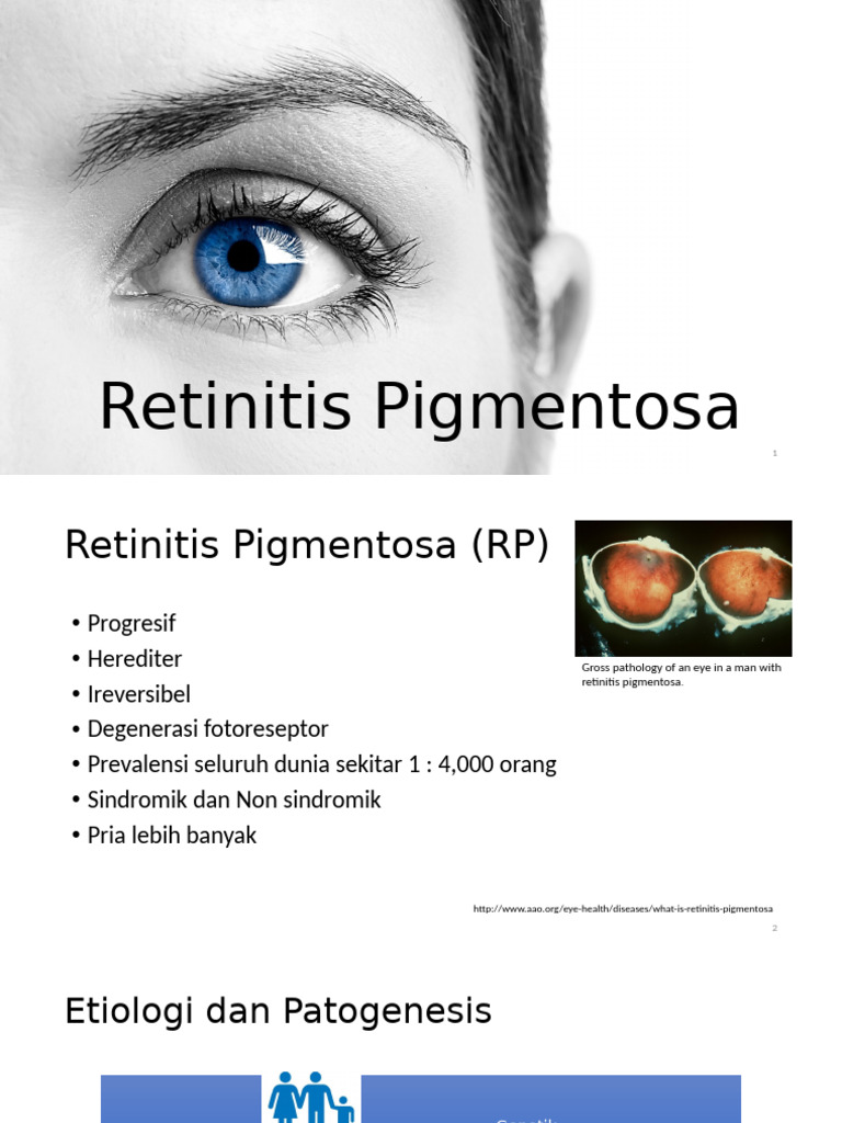 Retinitis Pigmentosa | PDF