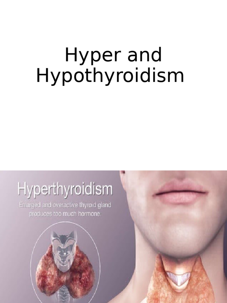 Lec 04.hyper & Hypo Thyroidism | PDF