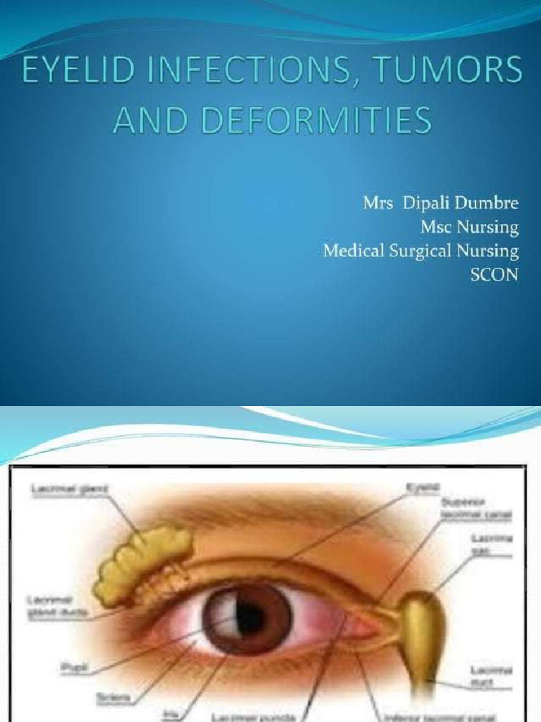 Eyelids Infection and Disorder | PDF