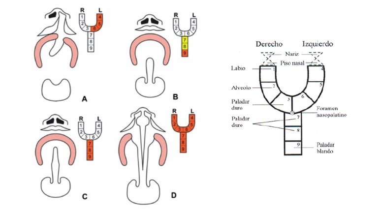 Labio y Paladar Hendido | PDF