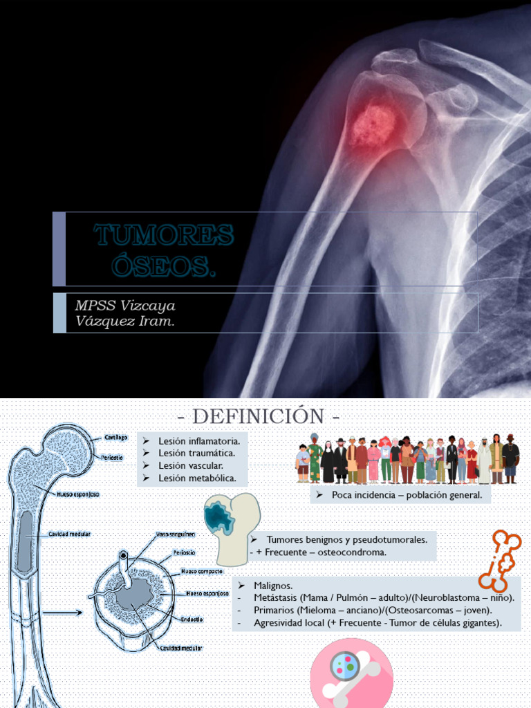 Tumores Óseos | PDF | Hueso | Neoplasias