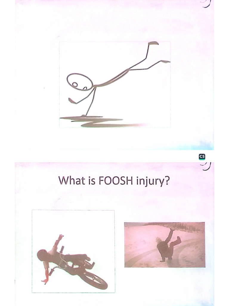 Colles' Fracture Introduction | PDF