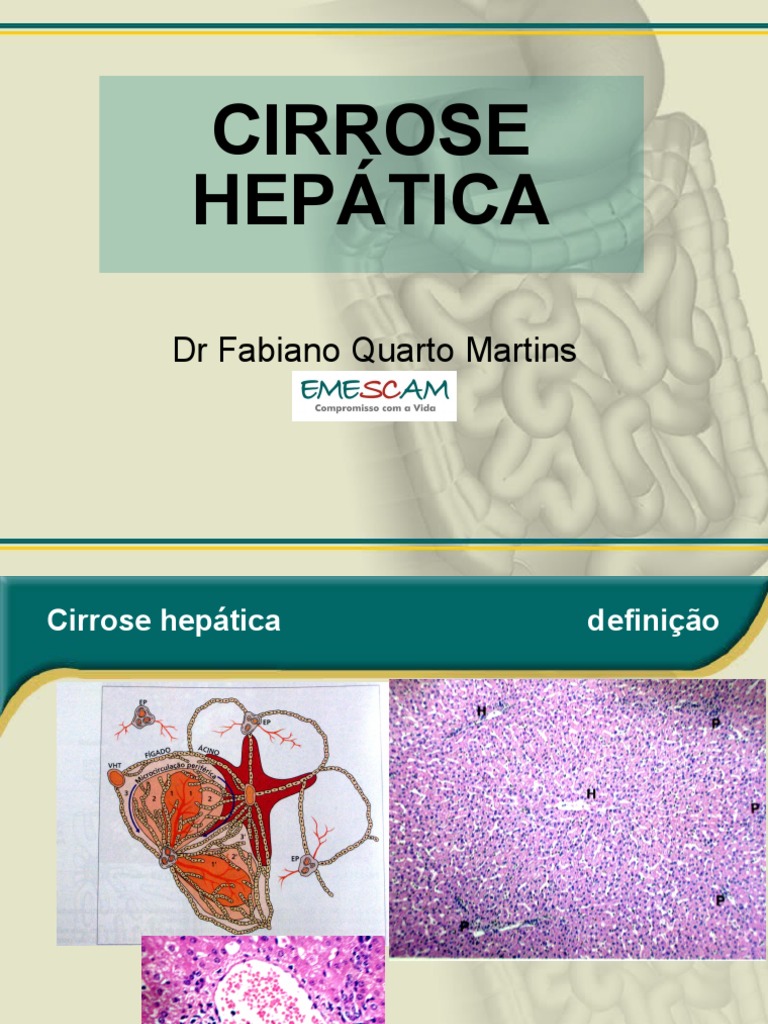 Cirrose Hepática: Classificação e Estigmas | PDF | Cirrose | Fígado