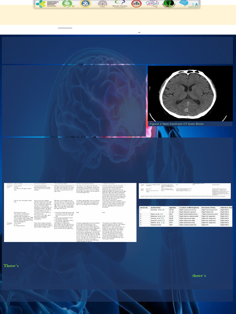 Is It Stroke Like Syndrome With Asymptomatic Meningioma | PDF | Stroke ...