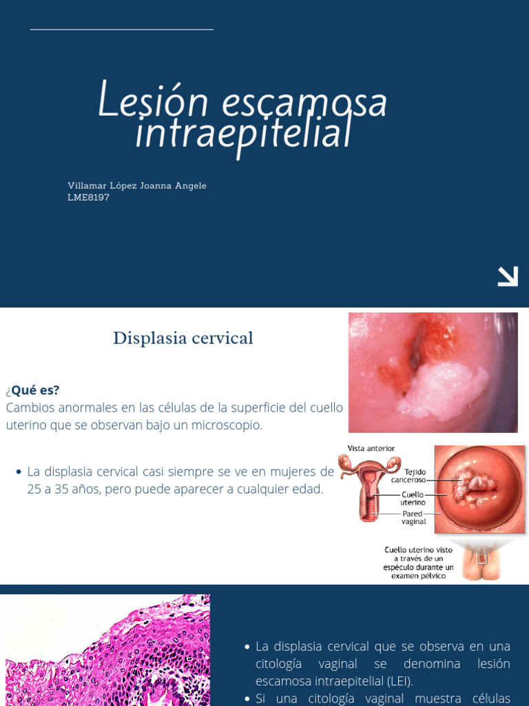 Lesión escamosa intraepitelial cervical | PDF | Cáncer de cuello ...