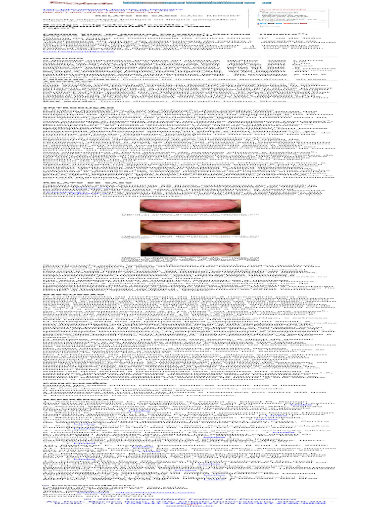Glossite Migratória Benigna Ou Língua Geográfica Relato de Caso Clínico ...