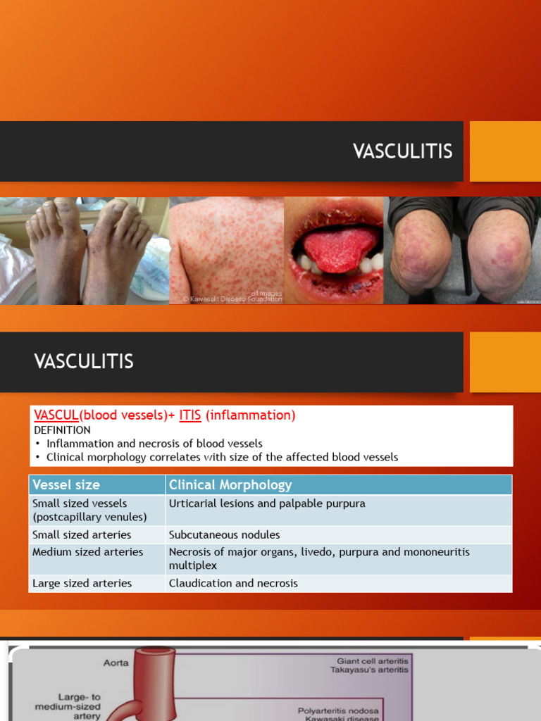 Understanding Vasculitis Types and Treatment | PDF | Diseases And ...