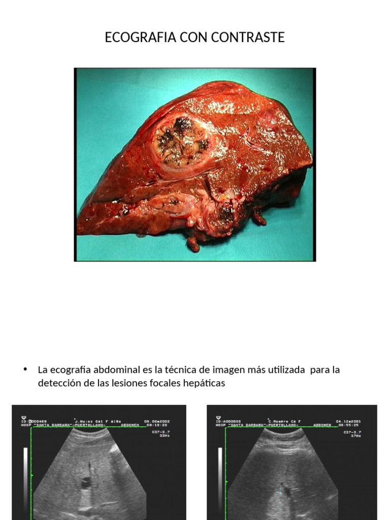 Eco Sonovue | PDF | Ultrasonido médico | Especialidades Medicas