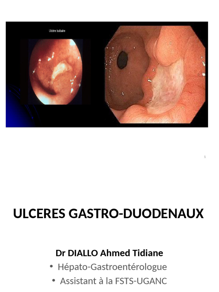 4-Les Ulcères Gastro-Duodénaux | PDF | Estomac | Gastroentérologie