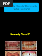Class IV Kennedy Removable Partial Denture | PDF | Dentures | Mouth