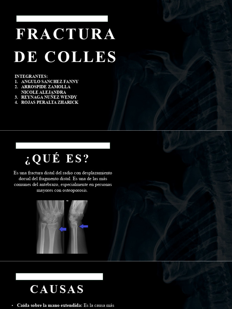 Fractura de Colles 1 (4) | PDF | Osteoporosis | Hueso