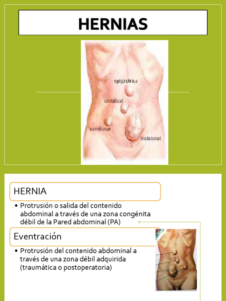 14 Hernias | PDF | Abdomen