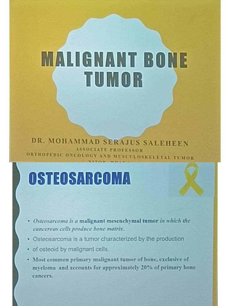 Osteosarcoma - DR - Saleheen Sir | PDF