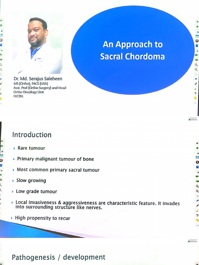 Sacral Chordoma Serajus Saleheen Sir | PDF