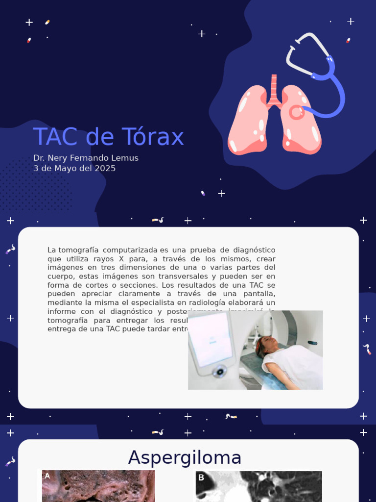 TAC de Torax y Tuberculosis | PDF | Tuberculosis | Ciencias de la Salud