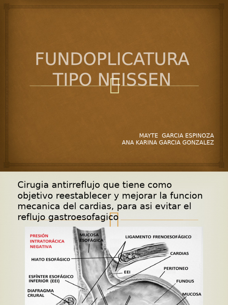 Funduplicatura Nissen y Complicaciones | PDF | Especialidades Medicas ...