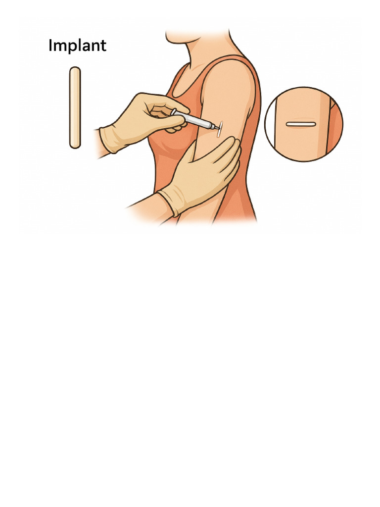 Ilustrasi KB Implant | PDF