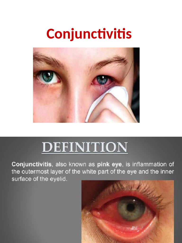 Conjunctivitis 1 | PDF