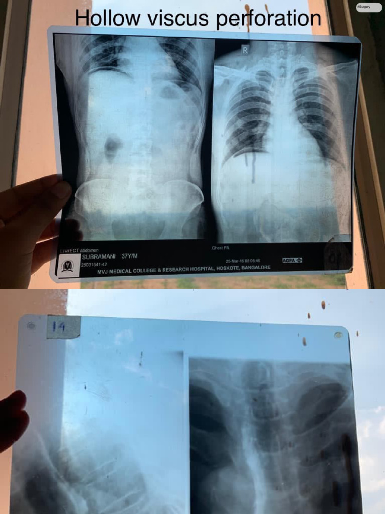 Hollow Viscus Perforation Surgery Guide | PDF
