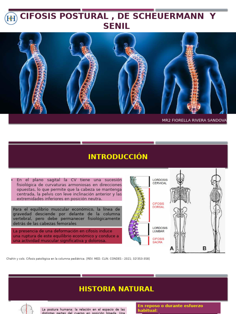 Cifosis Postural y Cifosis Scheuermann | PDF | La columna vertebral ...