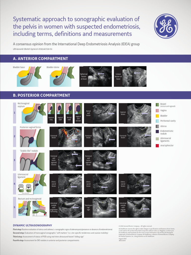 Sonographic Evaluation of Endometriosis | PDF | Rectum | Medical Ultrasound