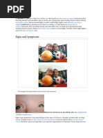 NS Grading of Cataract | PDF