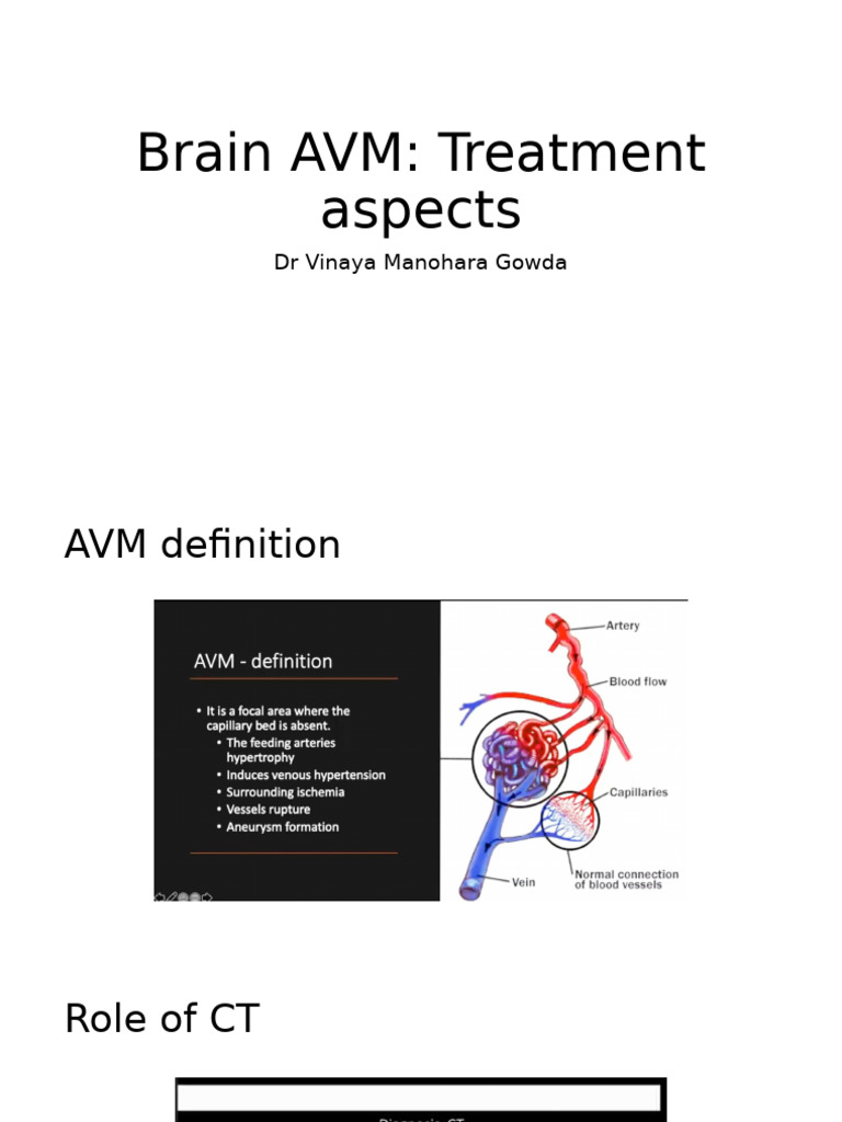 Brain AVM Treatment Overview | PDF