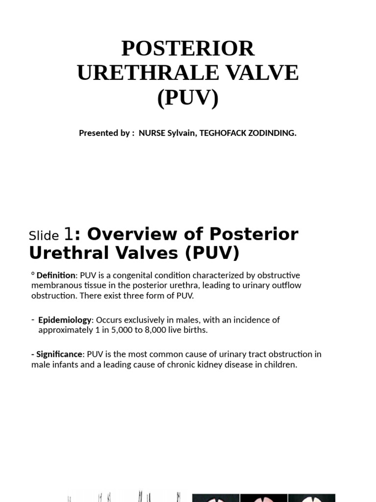 Overview of Posterior Urethral Valves | PDF