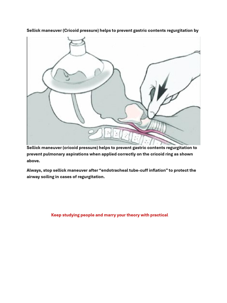 Sellick Maneuver for Airway Protection | PDF