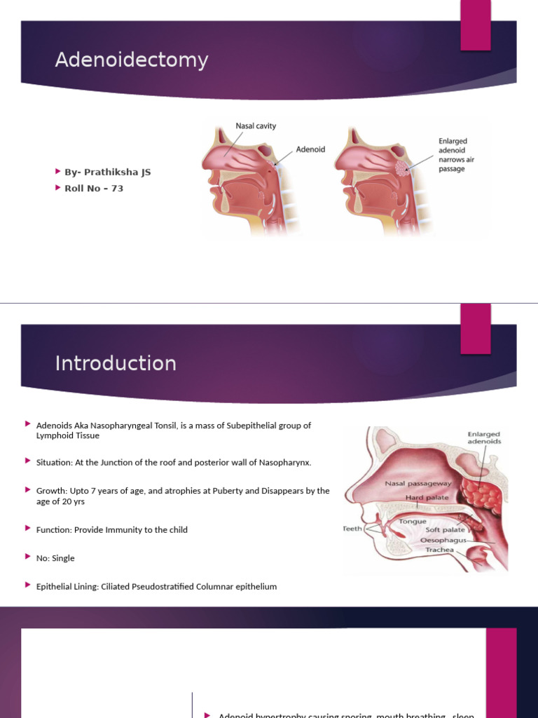 Overview of Adenoidectomy Procedures | PDF | Epithelium | Medical ...
