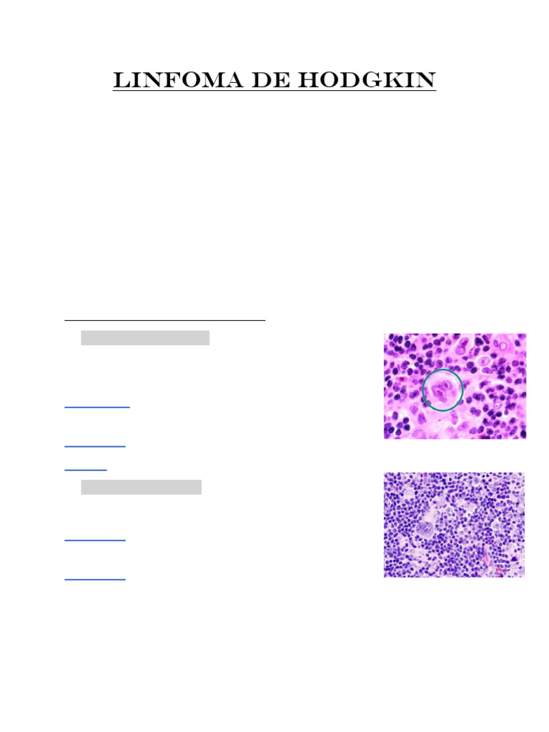 Linfoma de Hodgkin | PDF | Linfoma | Ganglio linfático