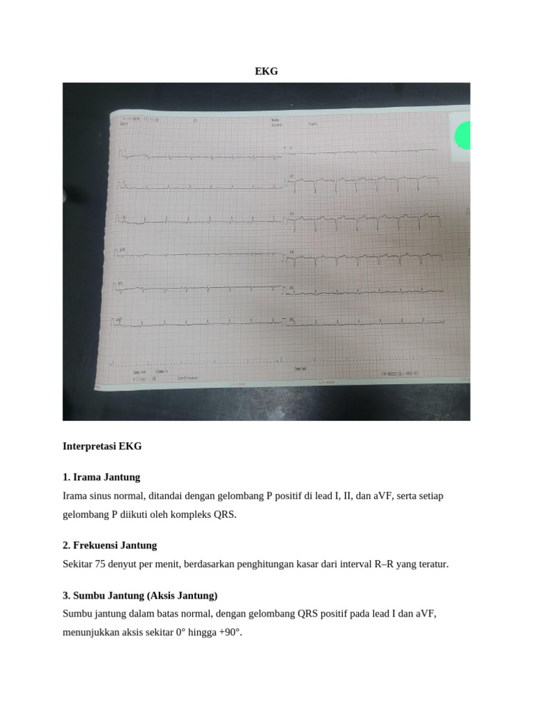 Interpretasi EKG Normal dan Irama Jantung | PDF