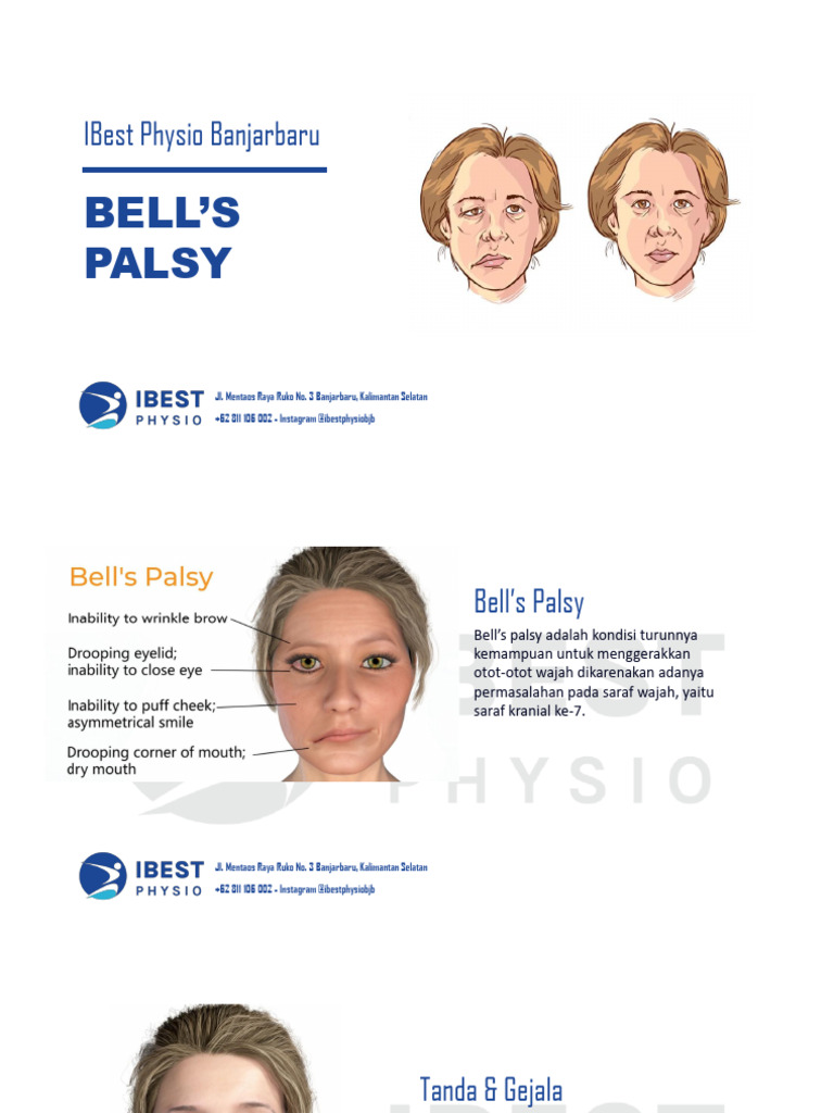Gejala dan Perawatan Bell's Palsy | PDF