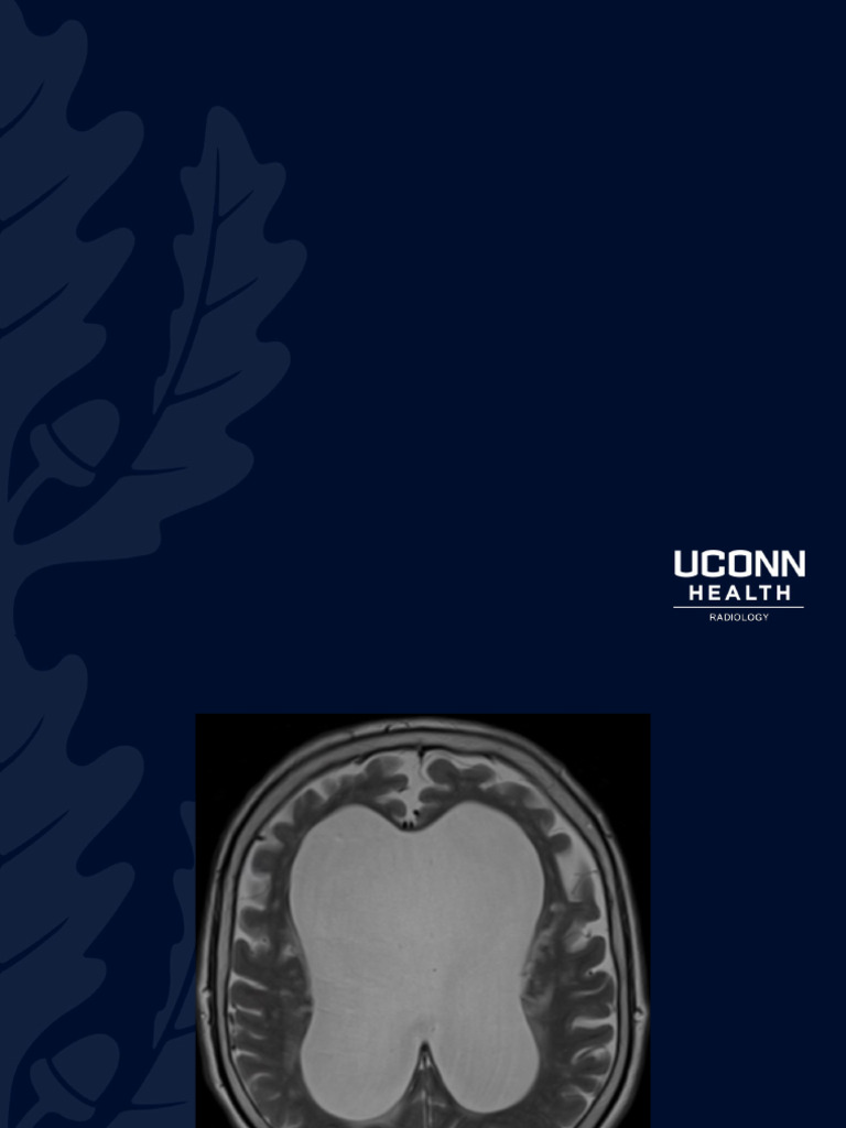 Communicating Hydrocephalus | PDF | Cerebrospinal Fluid | Neurological Disorders