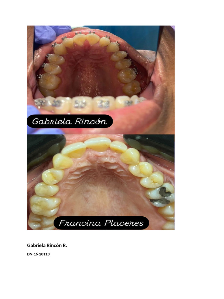 Caso Clínico Final PERIO I | PDF