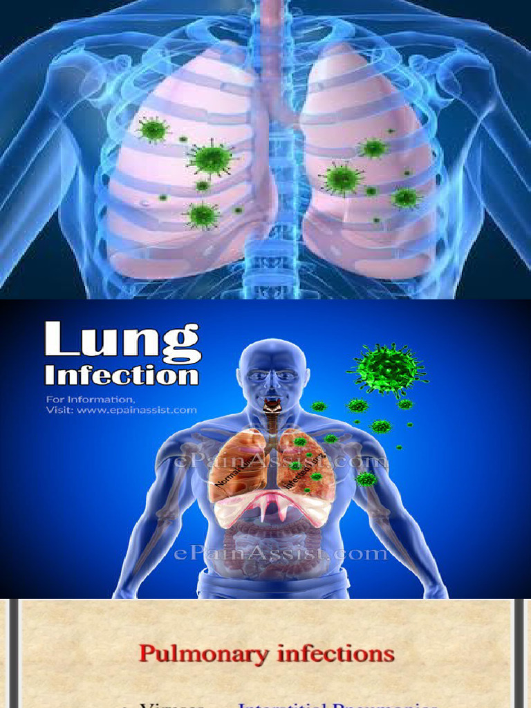 Infections of Lung 1 | PDF