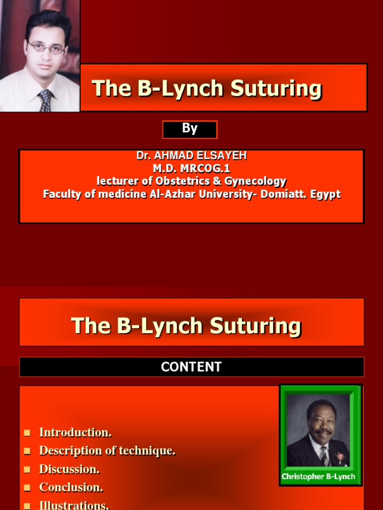 B Lynch Suture Full Article: Catastrophic Uterine Rupture Associated