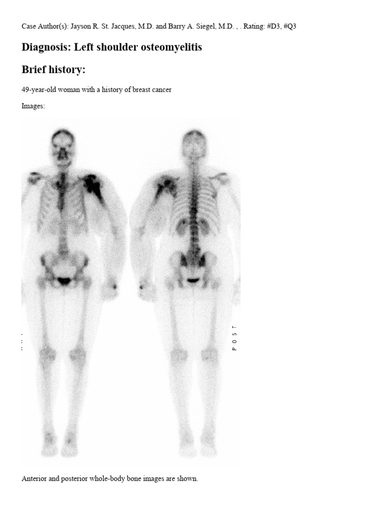 Left Shoulder Osteomyelitis | PDF | Shoulder | Metastasis