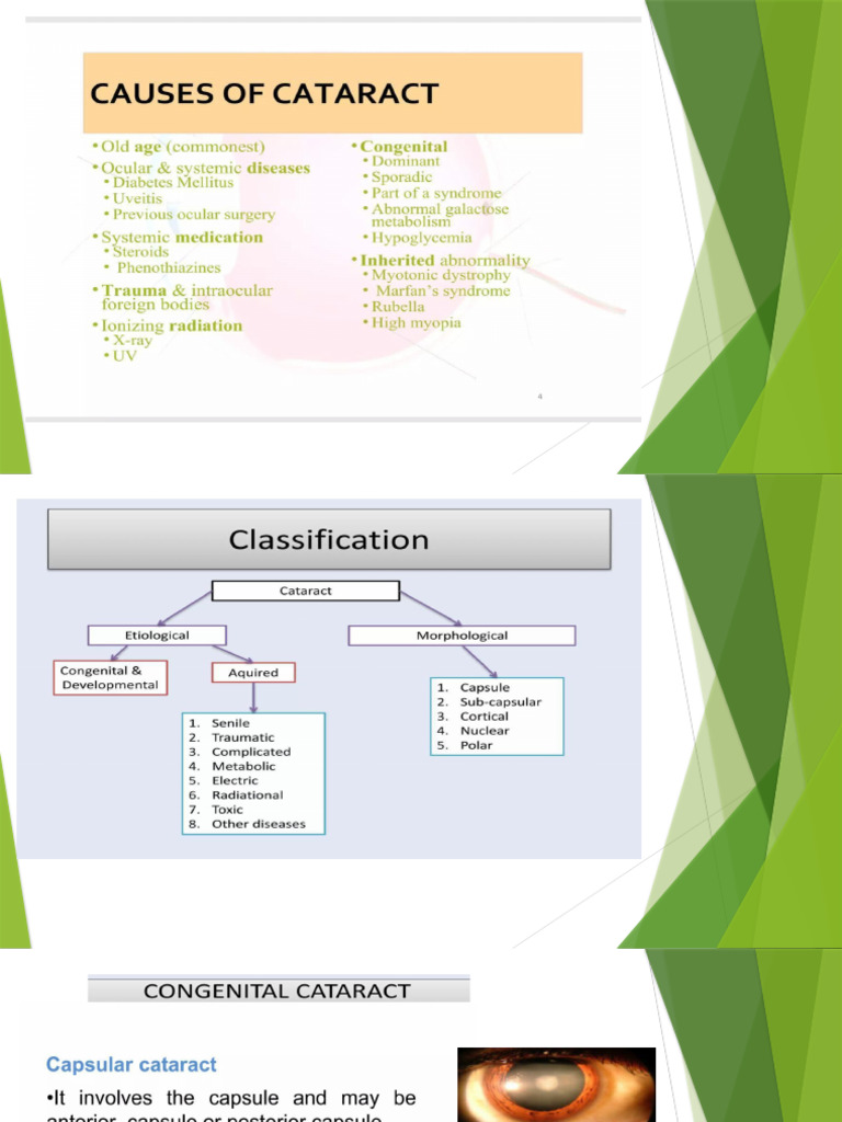 Types F Cataract | PDF
