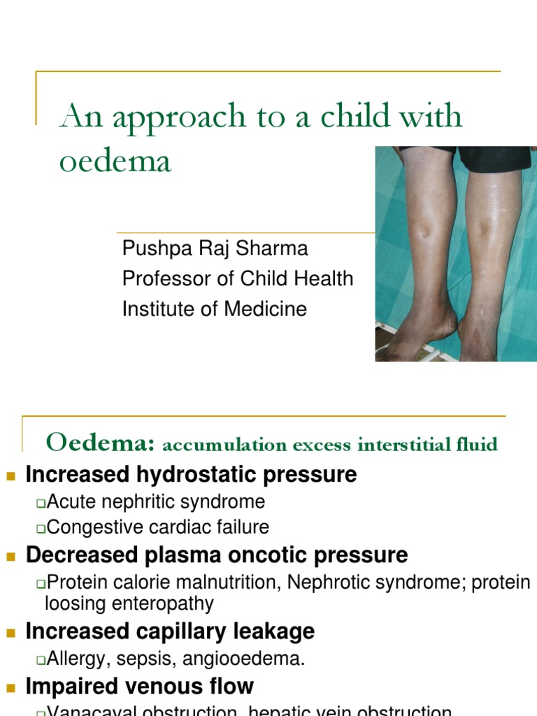 An Approach to a Child With Oedema | Edema | Medical Specialties