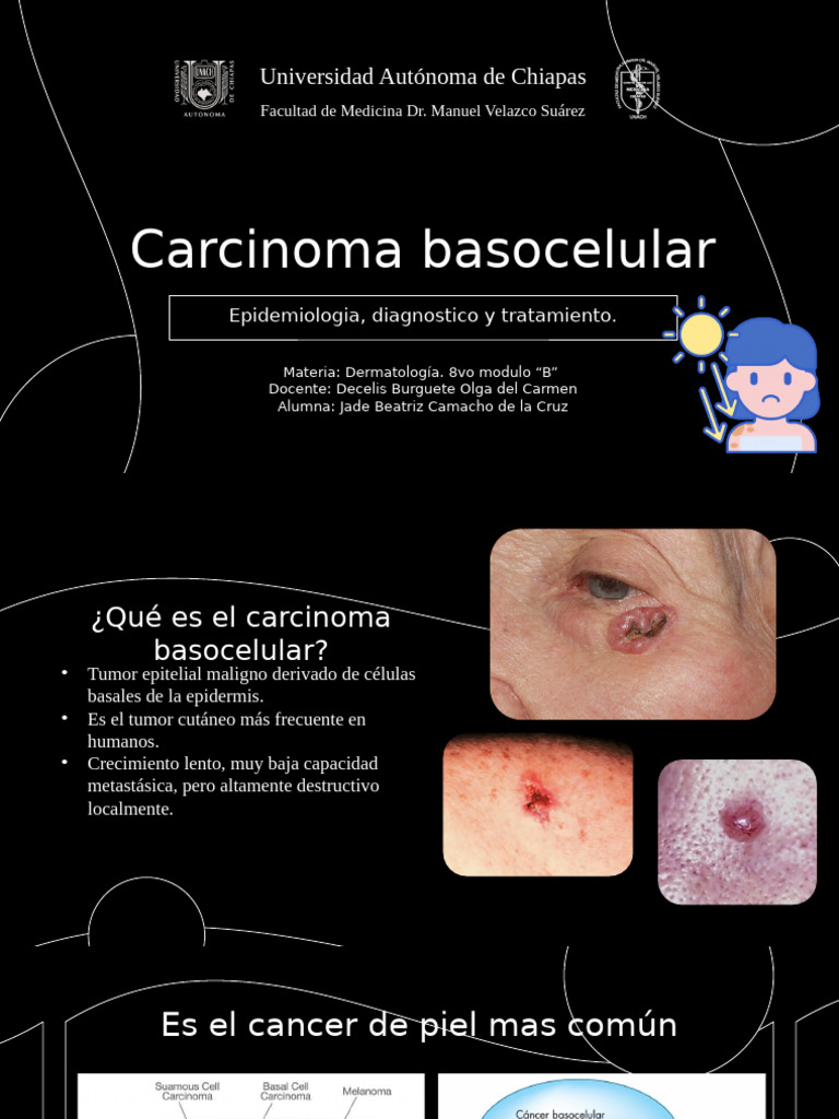 Carcinoma Basocelular: Diagnóstico y Tratamiento | PDF | Cáncer de piel ...