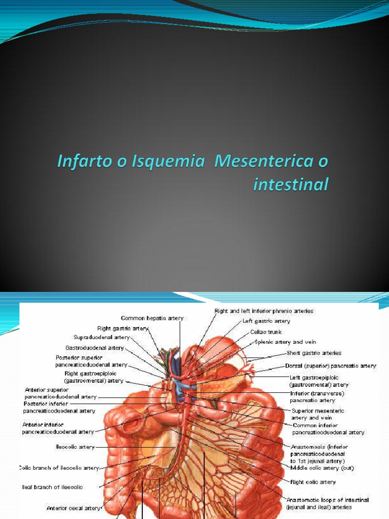 Isquemia Intestinal | Infarto de miocardio | Isquemia