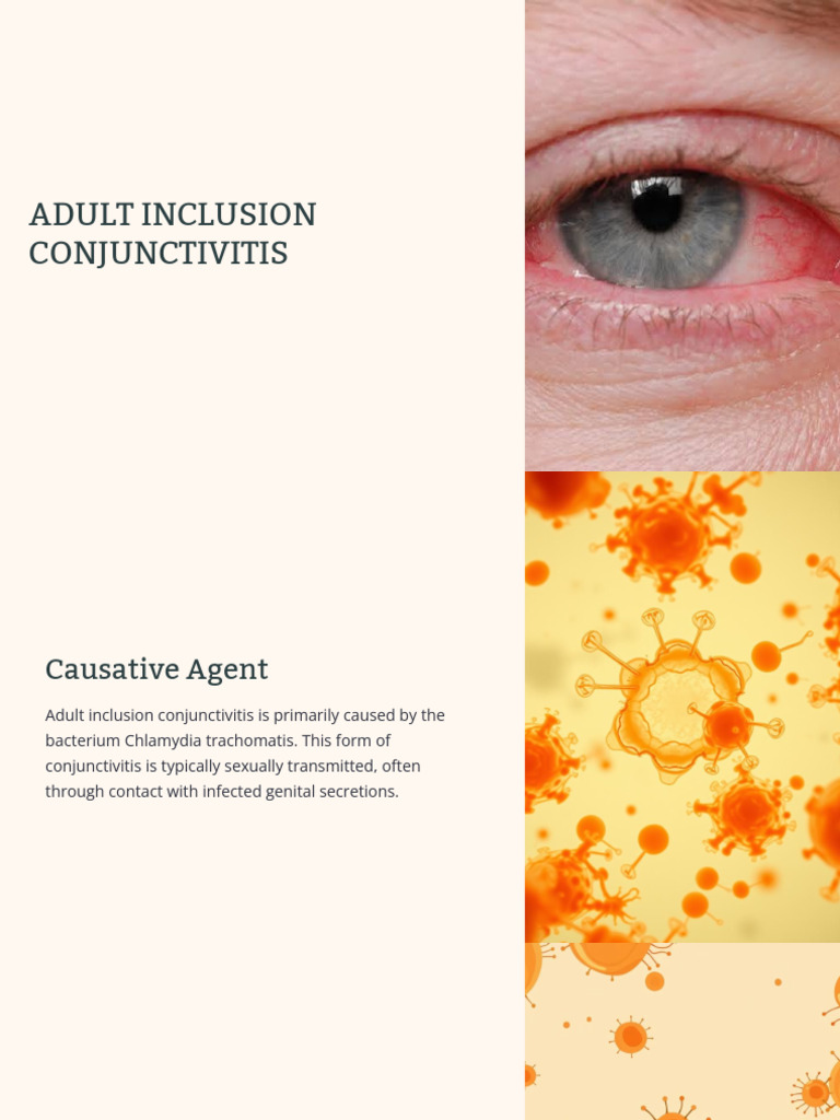 Adult-Inclusion-conjunctivitis (1) .PPTX 20250624 100519 0000 | PDF | Sexually Transmitted ...