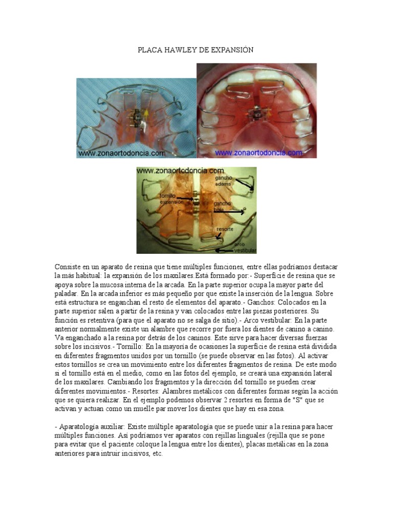 PLACA HAWLEY DE EXPANSIÓN | Lengua | Diente humano